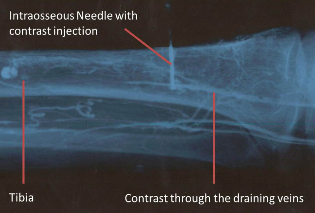 Ozyn-D: Intraosseous access device | School of International Biodesign